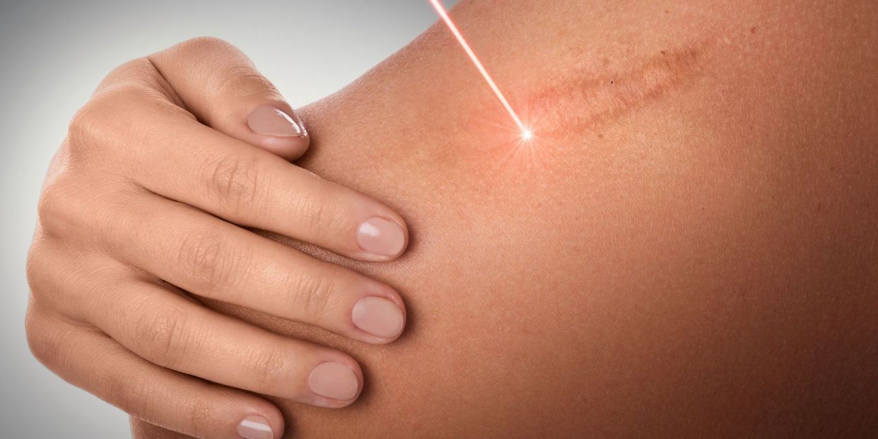 ¿Qué es un queloide y qué puedes hacer para mejorarlo?