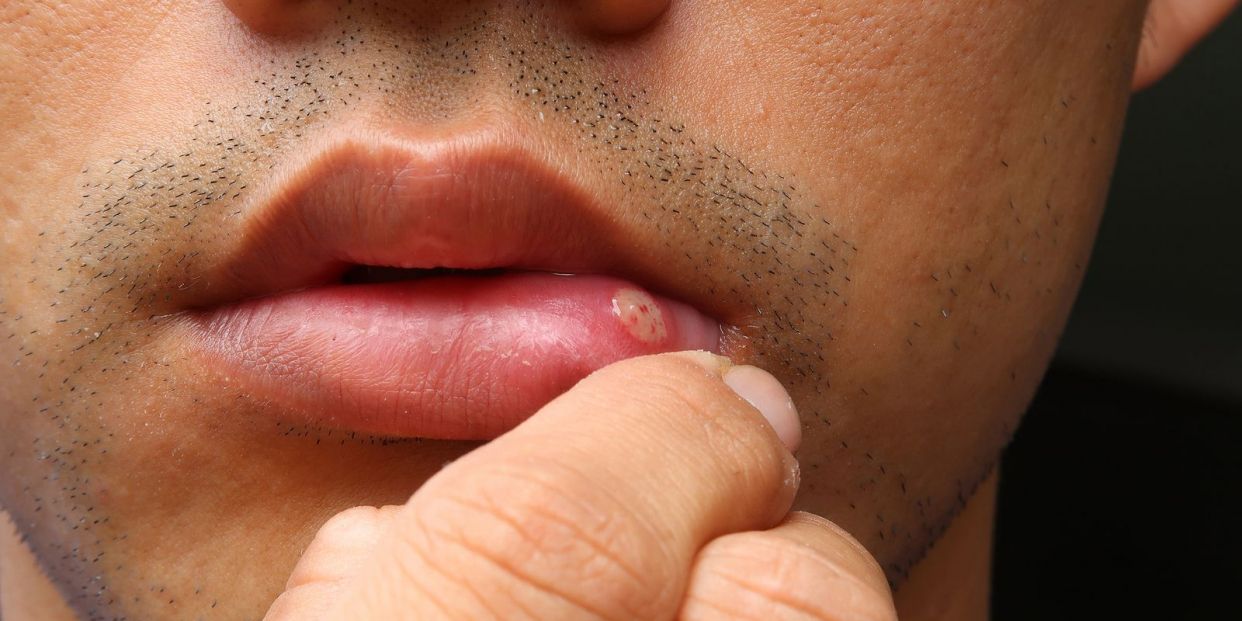 Cómo y por qué aparecen aftas o llagas en la boca
