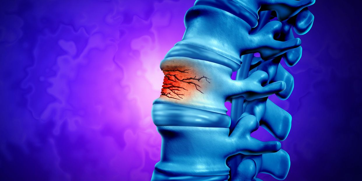 Loneliness also negatively affects bone health