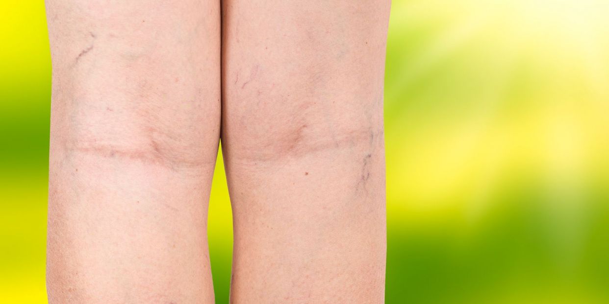 Flebectomía para eliminar las varices de forma ambulatoria