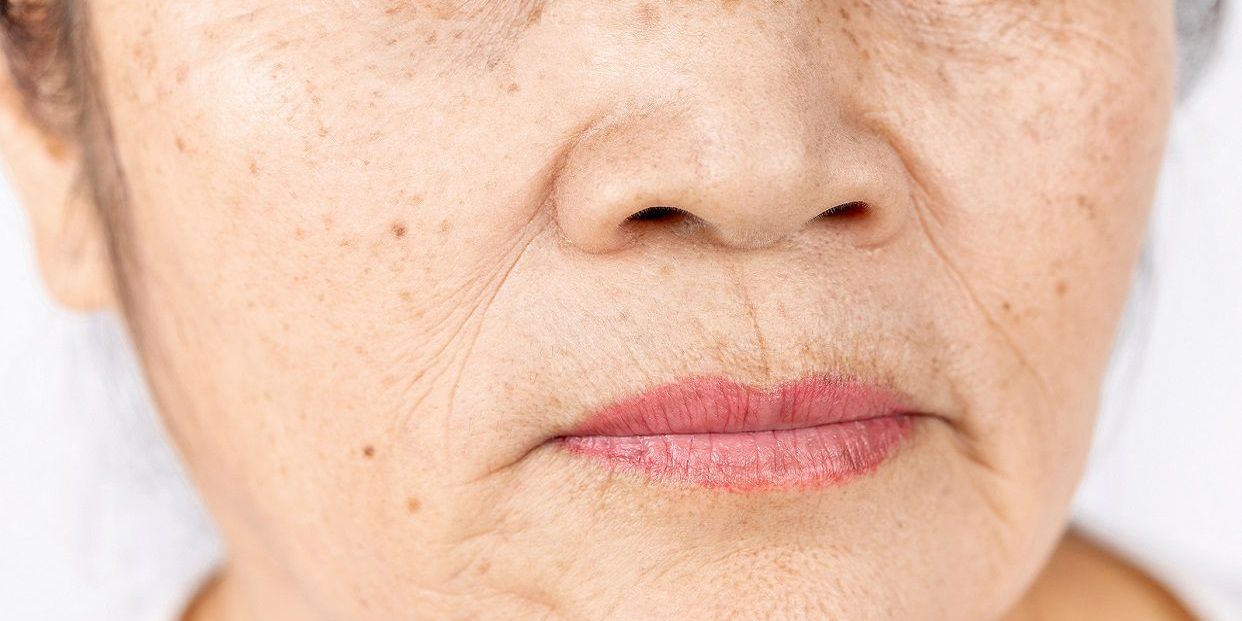 Qué son los puntos rojos en la piel