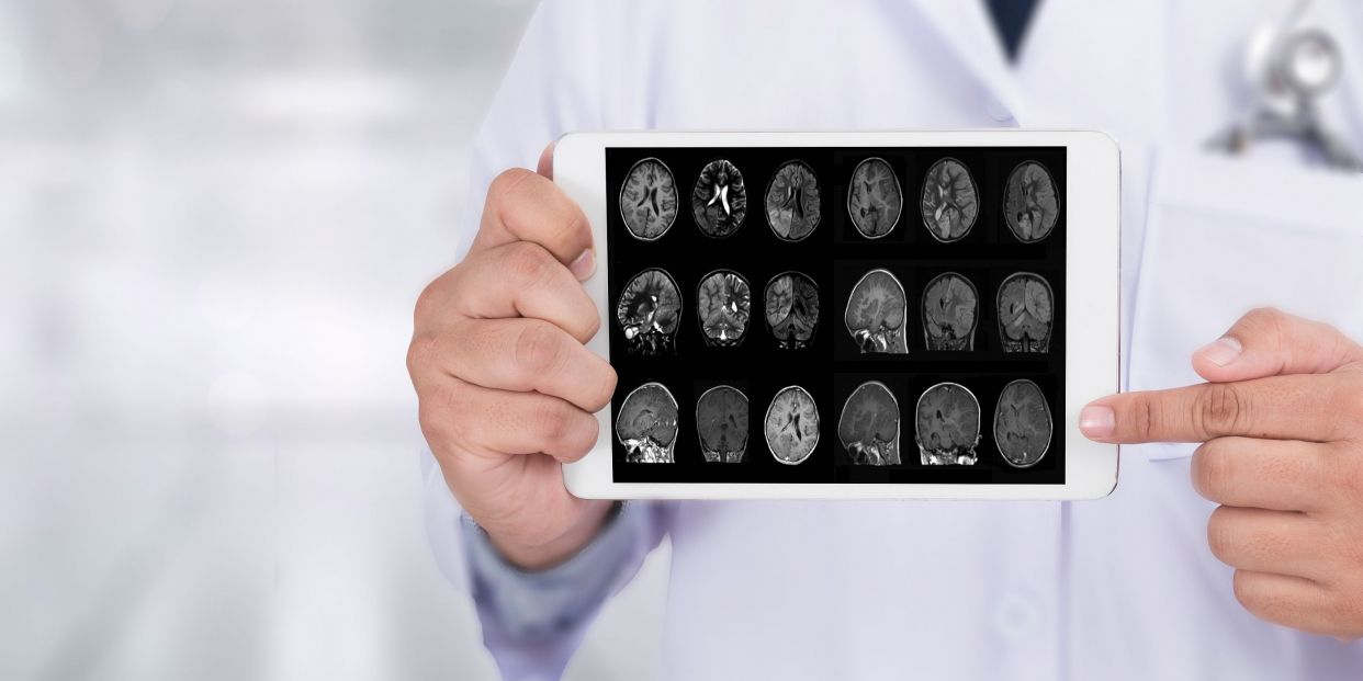 La grasa acumulada en el cerebro podría causar el alzhéimer