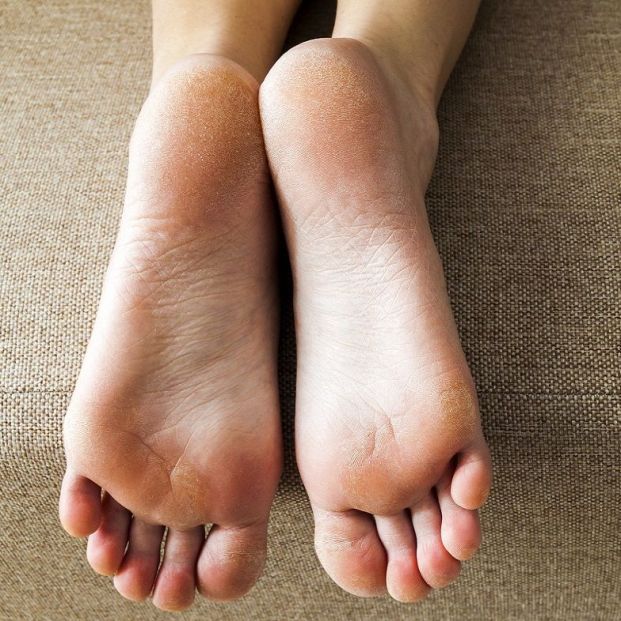 ¿Por qué aparecen los callos? Aprende a prevenirlos