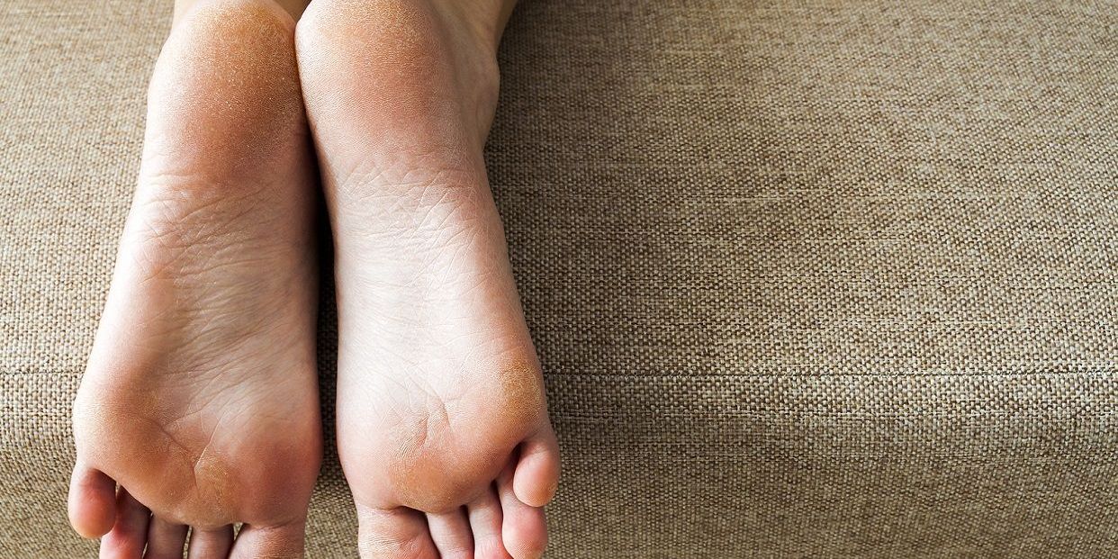 ¿Por qué aparecen los callos? Aprende a prevenirlos