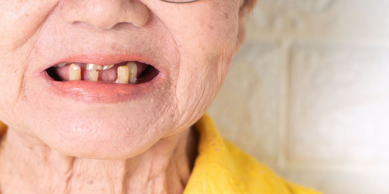 ¿Cuáles son las opciones si te faltan piezas dentales?