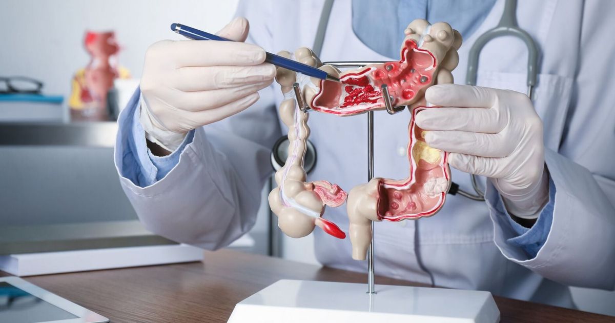 Alteraciones de microbiota y mayor riesgo de cáncer de colon