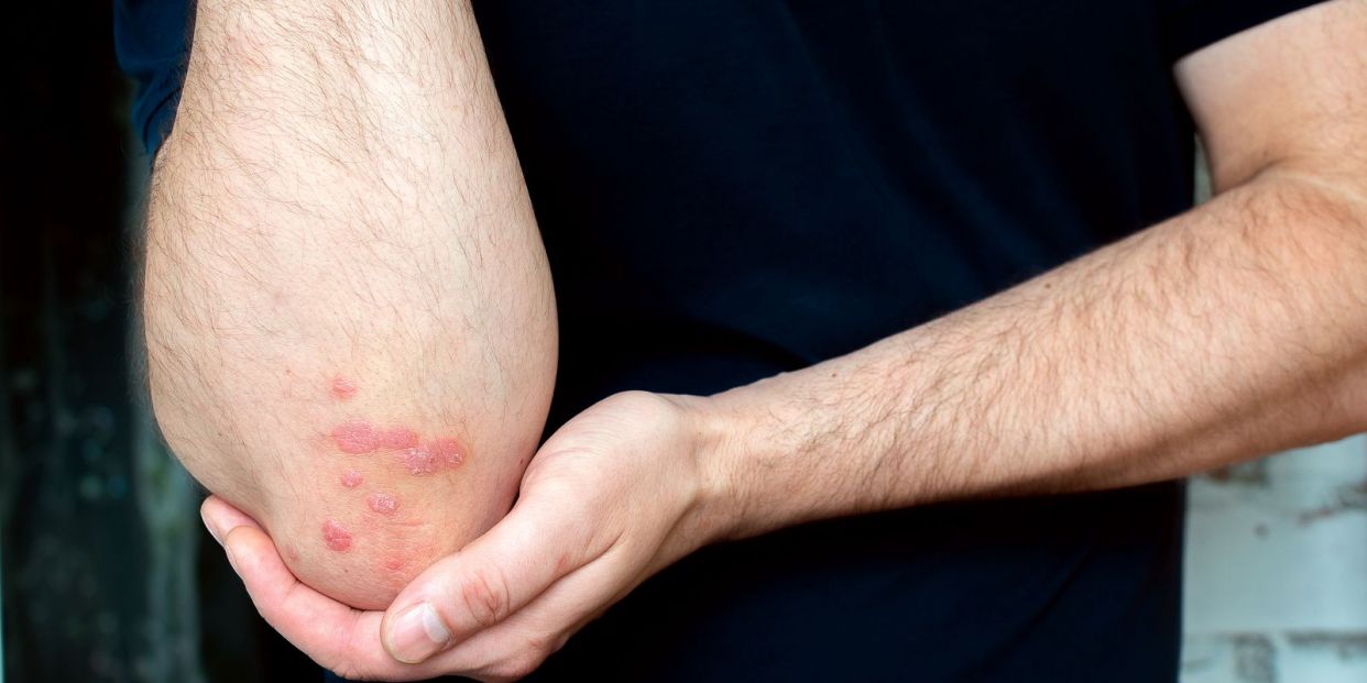 Síntomas más comunes de la psoriasis