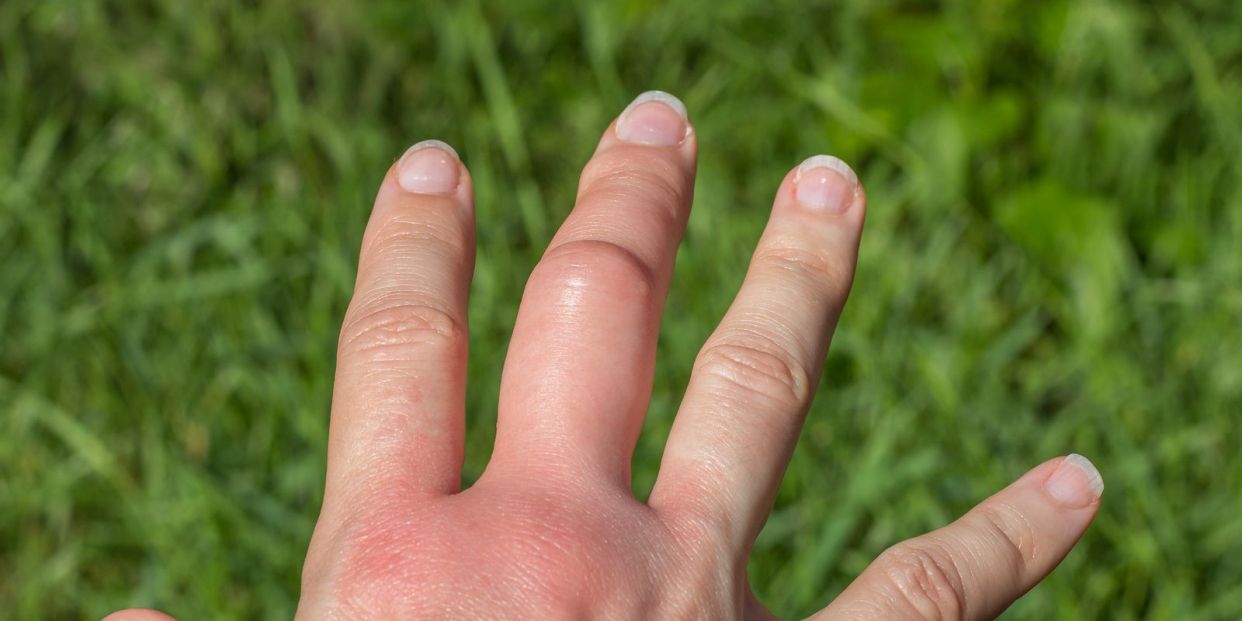 Cómo actuar ante las picaduras de mosca negra